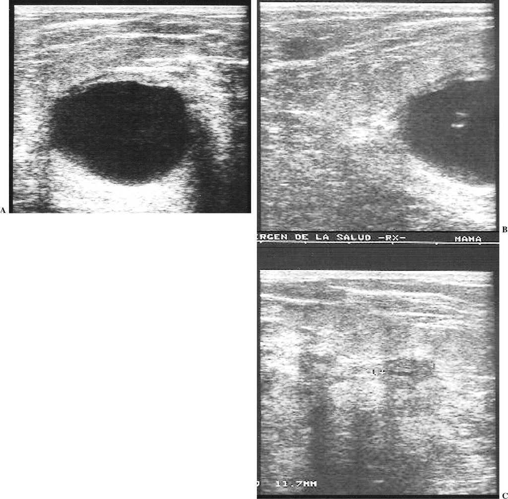 Diagnóstico y tratamiento de las lesiones benignas de la mama en el ...