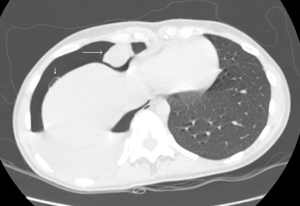 Neumotórax catamenial.Hallazgos radiológicos | Radiología