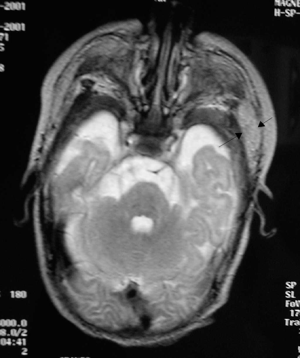 Parotiditis aguda neonatal por Streptococcus agalactiae | Anales de ...