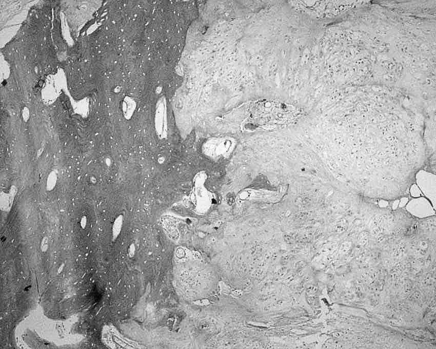 Condromas periósticos de la mano | Revista Española de Cirugía ...