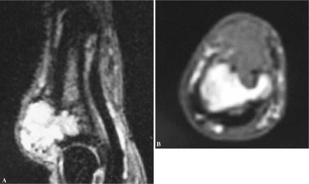 Condromas periósticos de la mano | Revista Española de Cirugía ...