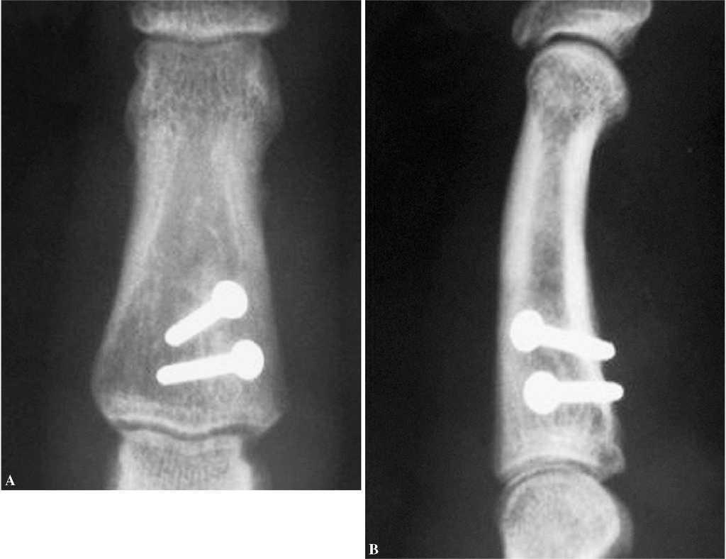 Condromas periósticos de la mano | Revista Española de Cirugía ...