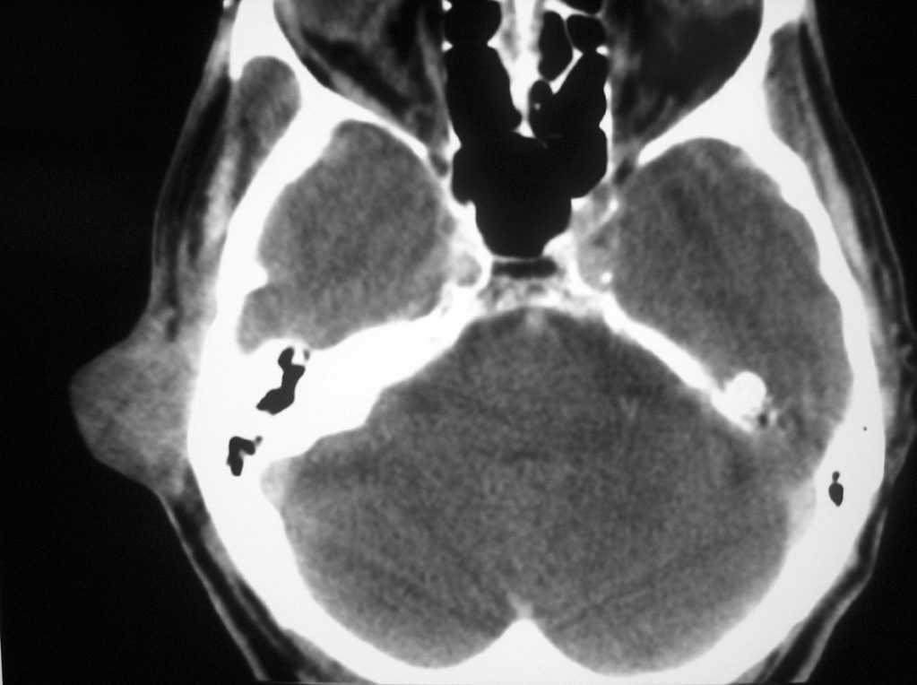 Carcinoma de células de Merkel. A propósito de dos casos | Radiología