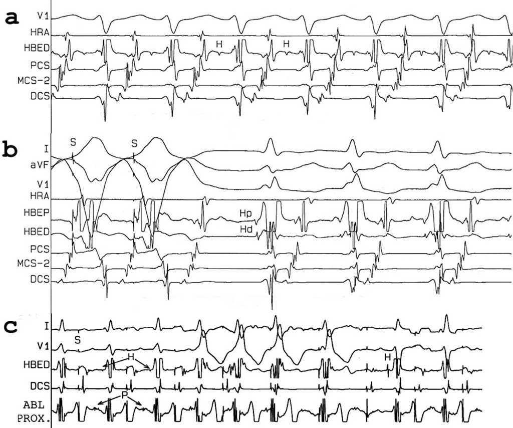 Ablation of a Mahaim Accessory Pathway Connected to the Left Ventricle ...