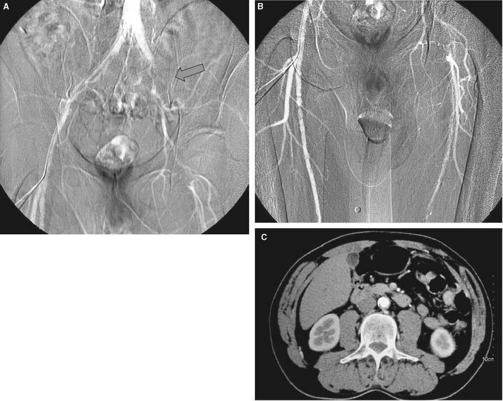 By-pass aortobifemoral con asistencia laparoscópica por vía ...