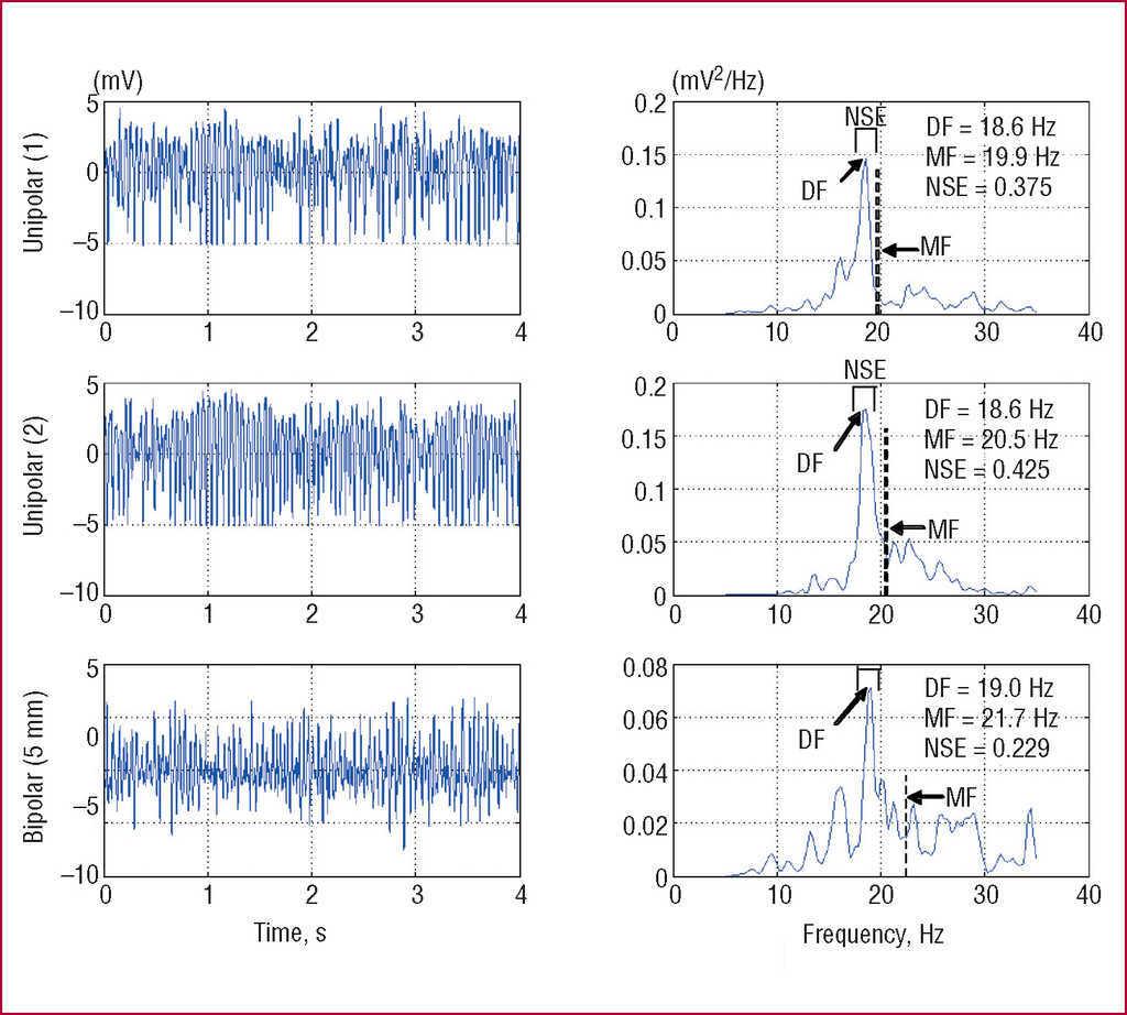 Influence of Recording Mode (Unipolar or Bipolar) on the Spectral ...