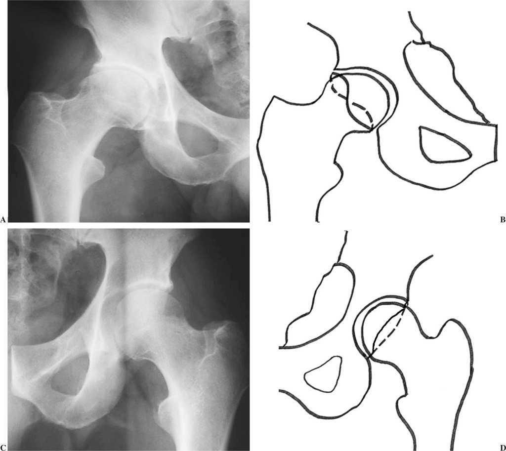 Atrapamiento fémoro-acetabular anterior. Signos radiológicos en ...