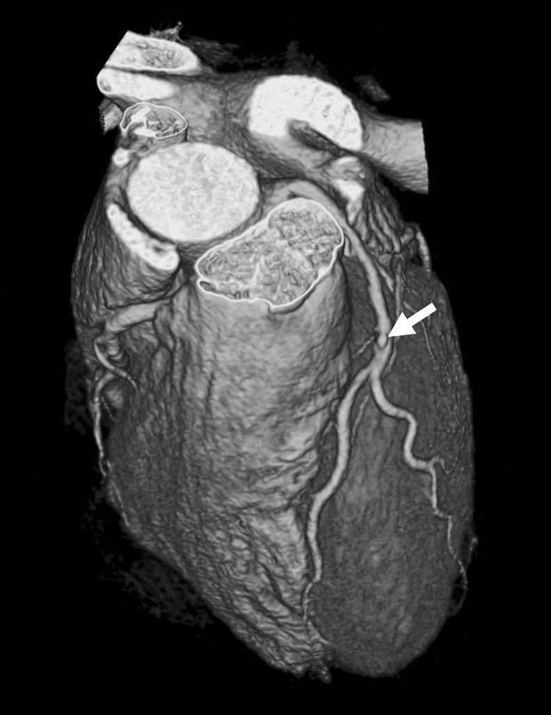 Angiografía por tomografía computarizada coronaria: indicaciones ...