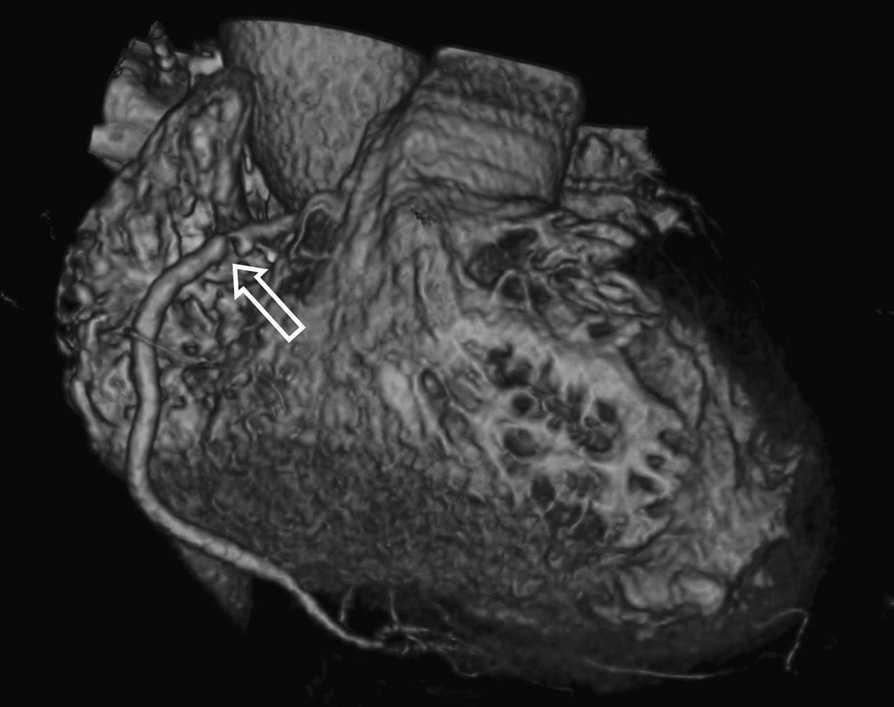 Angiografía por tomografía computarizada coronaria: indicaciones ...