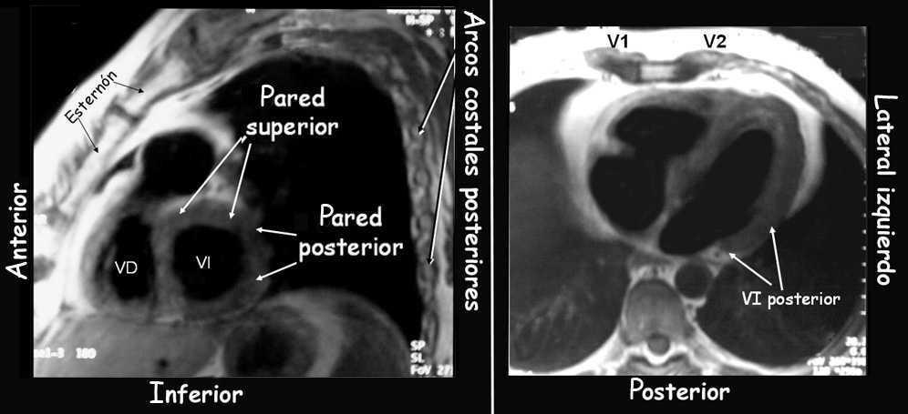 El infarto posterior existe | Revista Española de Cardiología