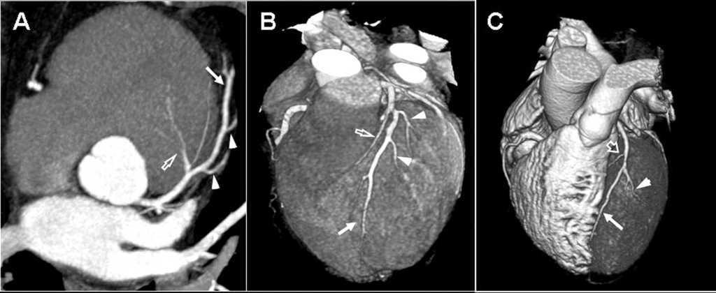 Anatomía normal, variantes anatómicas y anomalías del origen y trayecto ...