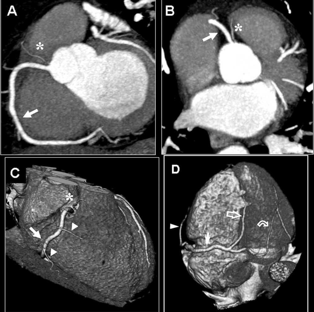 Anatomía normal, variantes anatómicas y anomalías del origen y trayecto ...