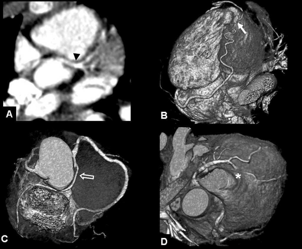 Anatomía normal, variantes anatómicas y anomalías del origen y trayecto ...