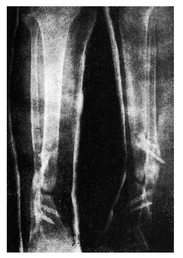 Contribución al tratamiento quirúrgico de la pseudoartrosis infectada ...