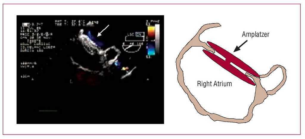 Correction of the Perpendicular Positioning of the Amplatzer Device ...