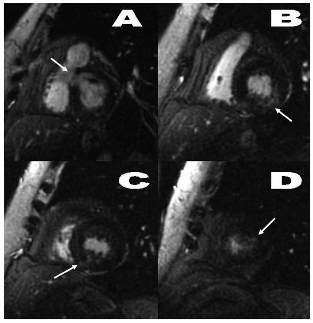 Cardiac Sarcoidosis: Diagnosis by Contrast-Enhanced Magnetic Resonance ...