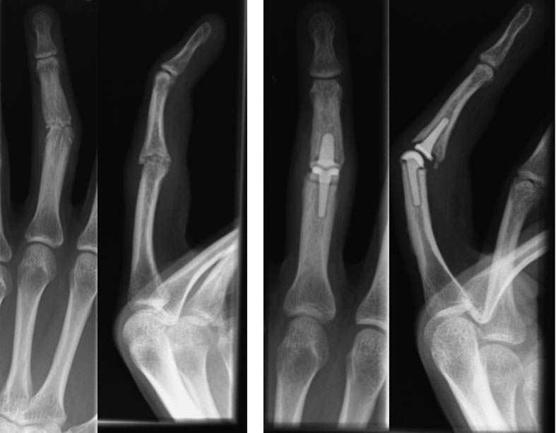 Artroplastia interfalángica proximal con prótesis de carbón pirolítico ...