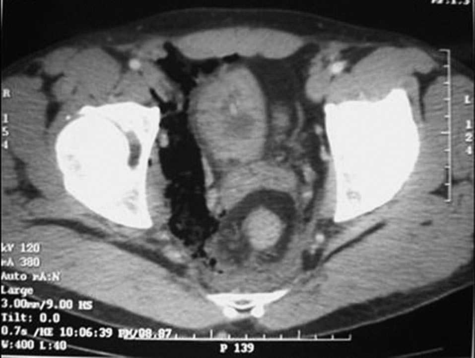 Nuevo caso de retroneumoperitoneo secundario al lavado con agua ...