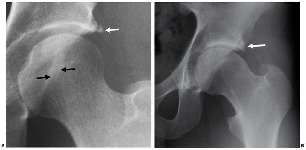 El atrapamiento femoroacetabular: diagnóstico radiográfico. Lo que el ...