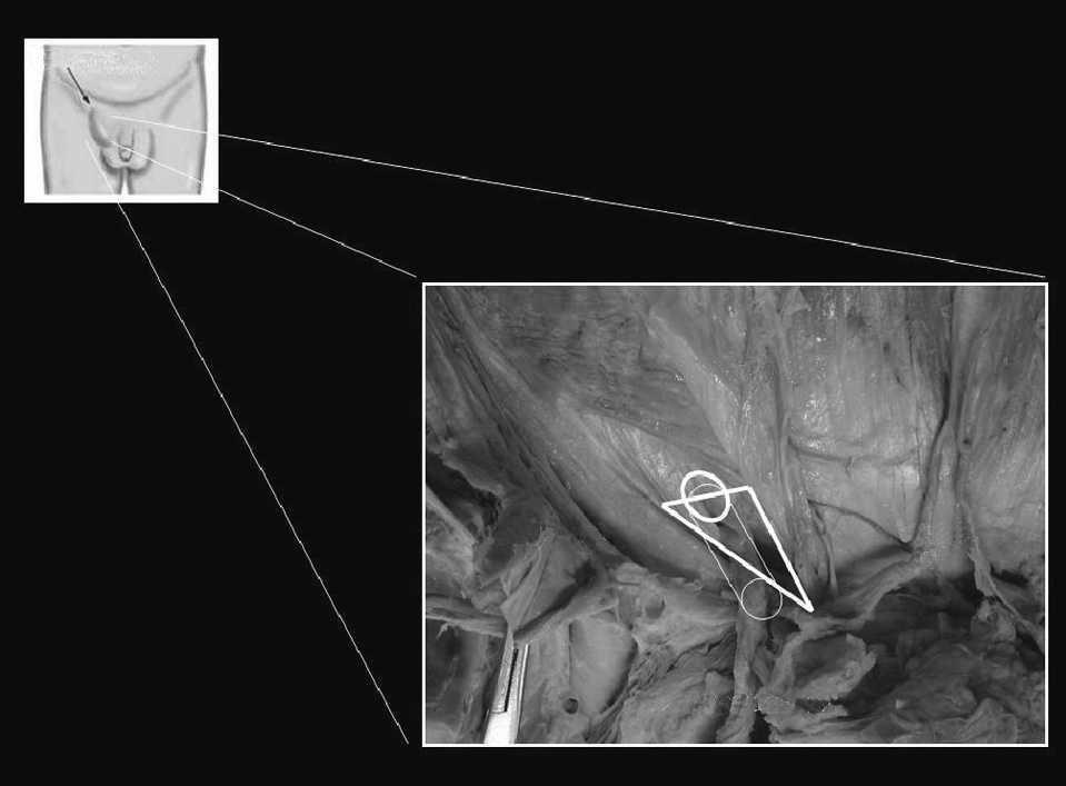 Simulación virtual de la región inguinal humana | Cirugía Española
