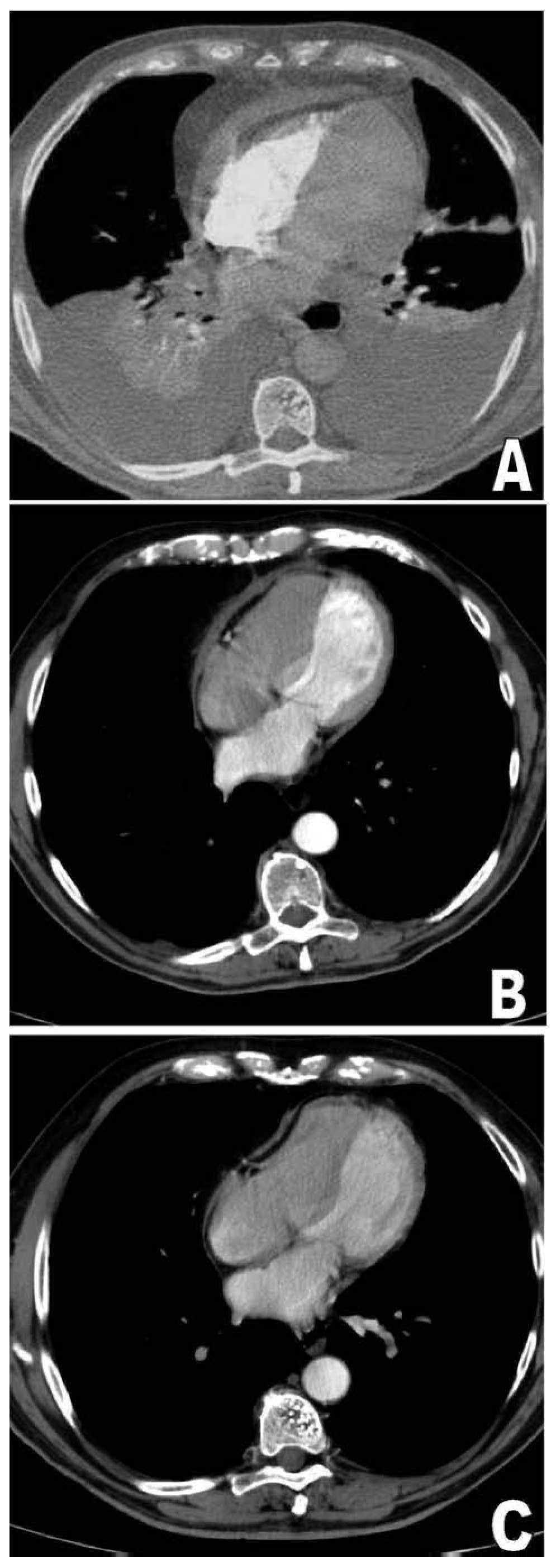 Transient Cardiac Constriction With Severe Heart Failure | Revista ...