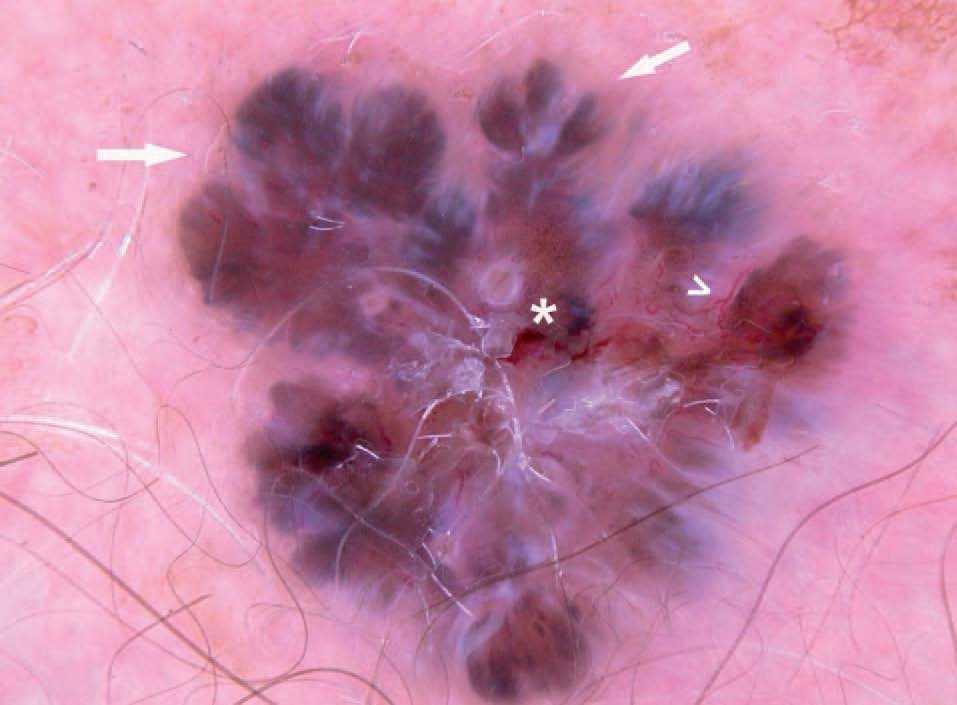 Dermatoscopia de lesiones no melanocíticas. Parte 2 | Piel. Formación ...