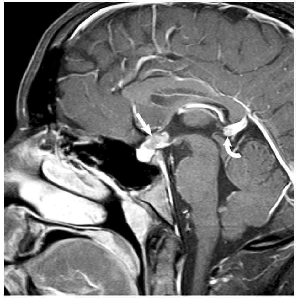 Anatomía y espectro patológico de las lesiones del infundíbulo ...