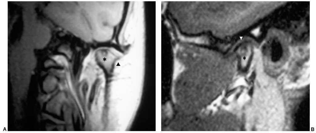 Resonancia magnética de la articulación temporomandibular | Radiología