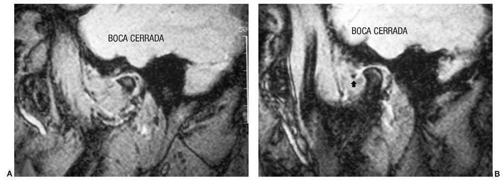 Resonancia magnética de la articulación temporomandibular | Radiología