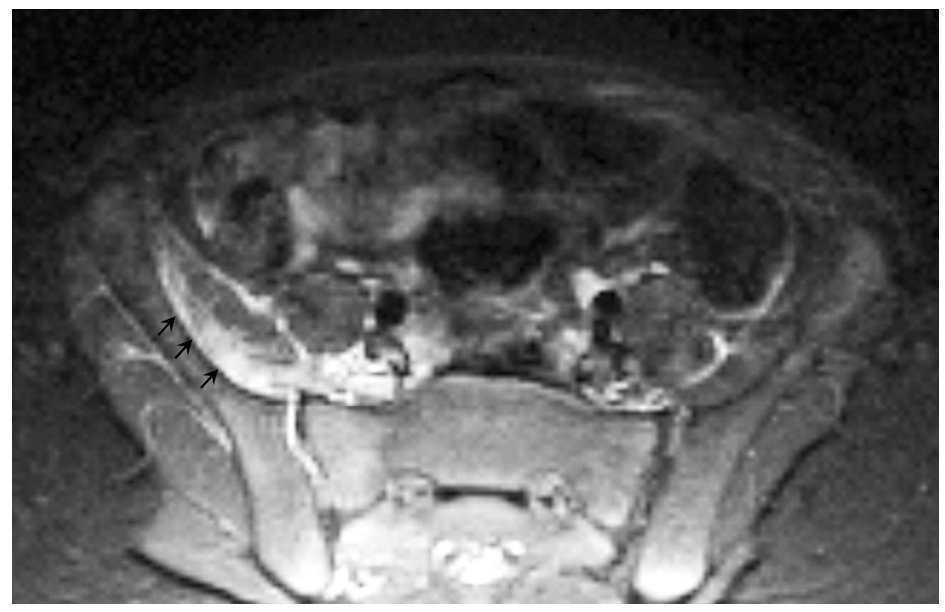 Papel de la resonancia magnética en el diagnóstico precoz de la ...