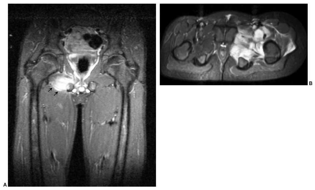 Papel de la resonancia magnética en el diagnóstico precoz de la ...