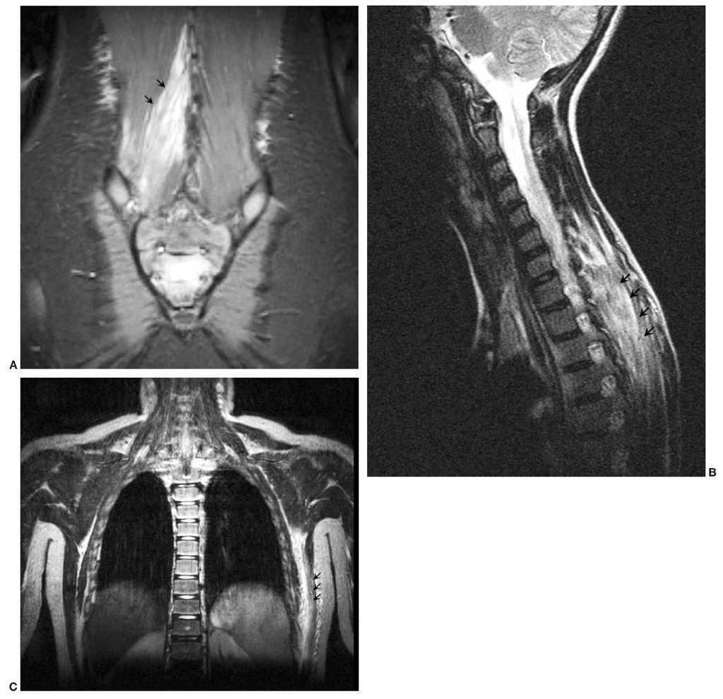 Papel de la resonancia magnética en el diagnóstico precoz de la ...