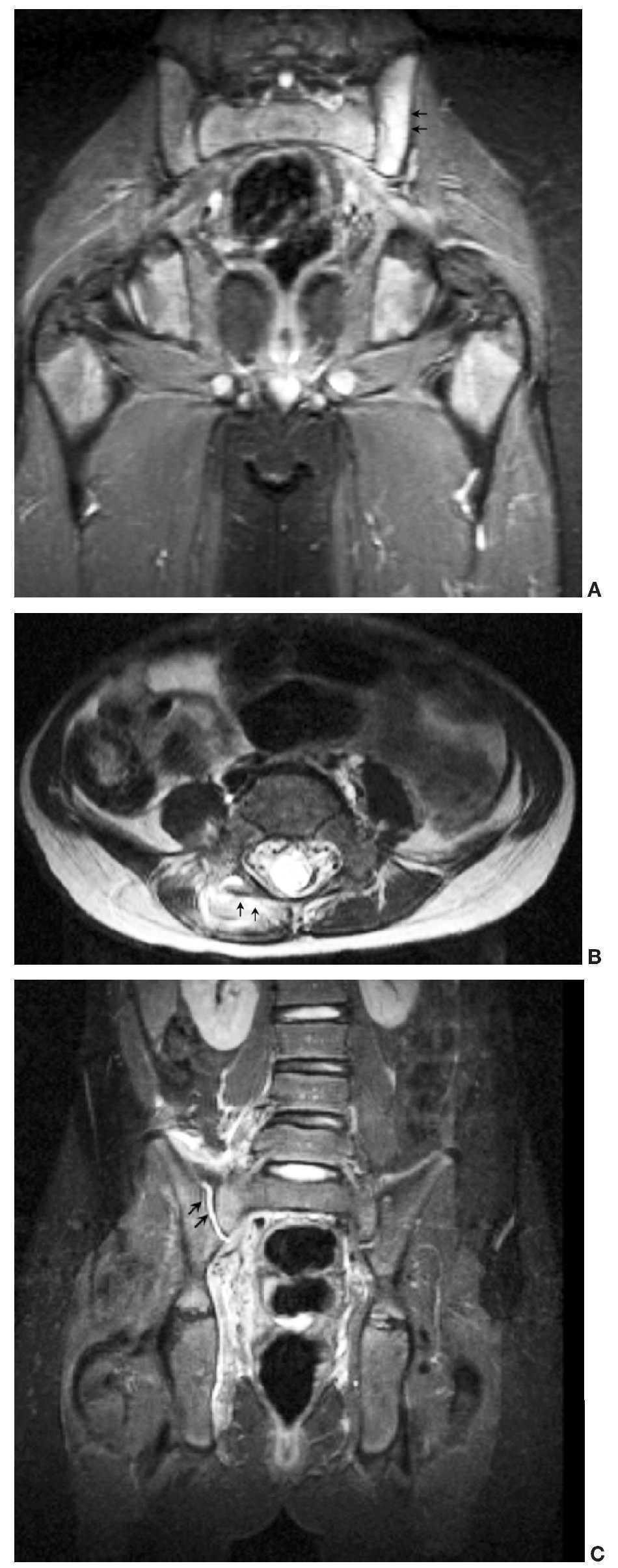 Papel de la resonancia magnética en el diagnóstico precoz de la ...