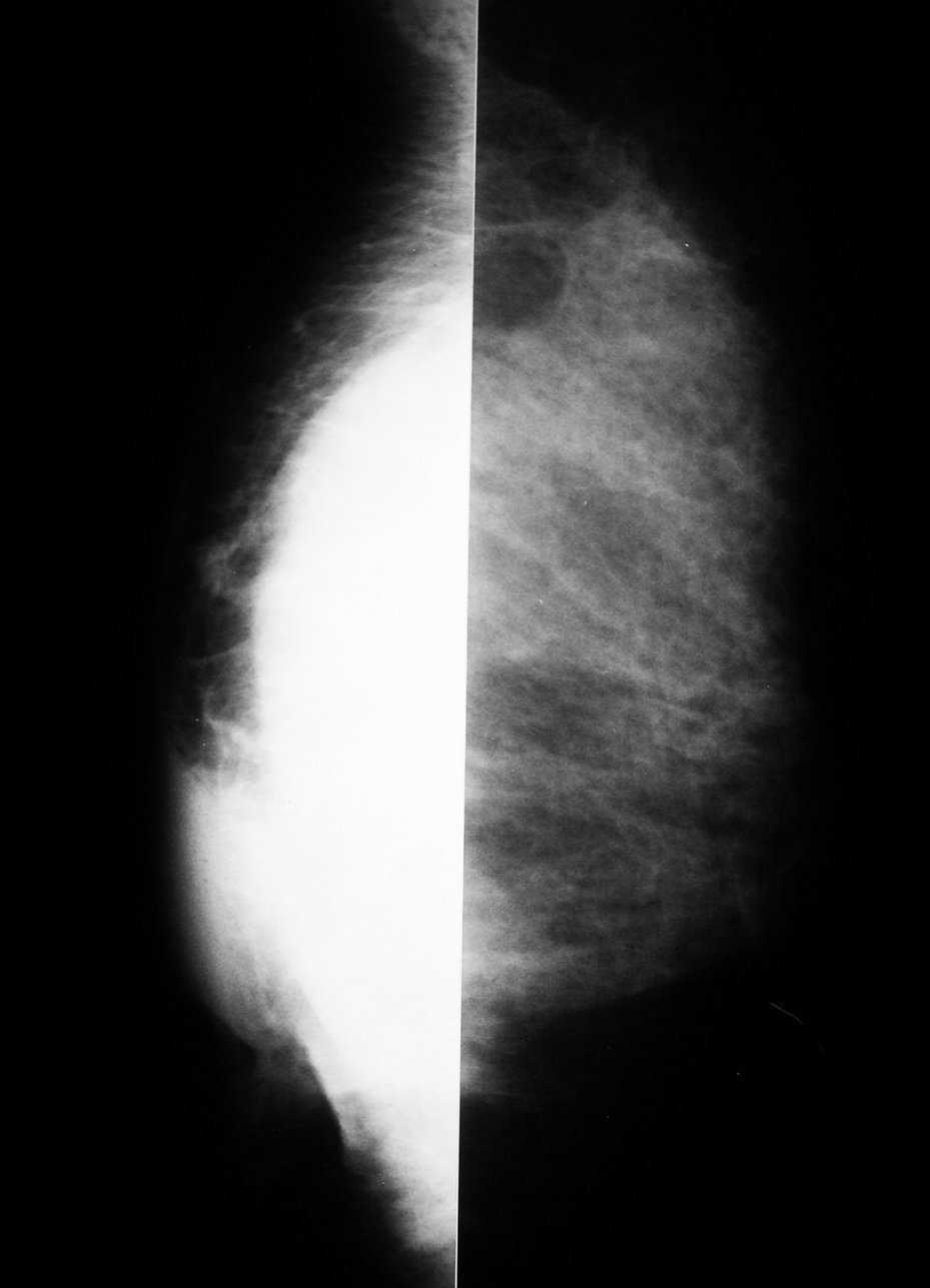Tuberculosis mamaria. Descripción de los hallazgos de imagen en dos ...