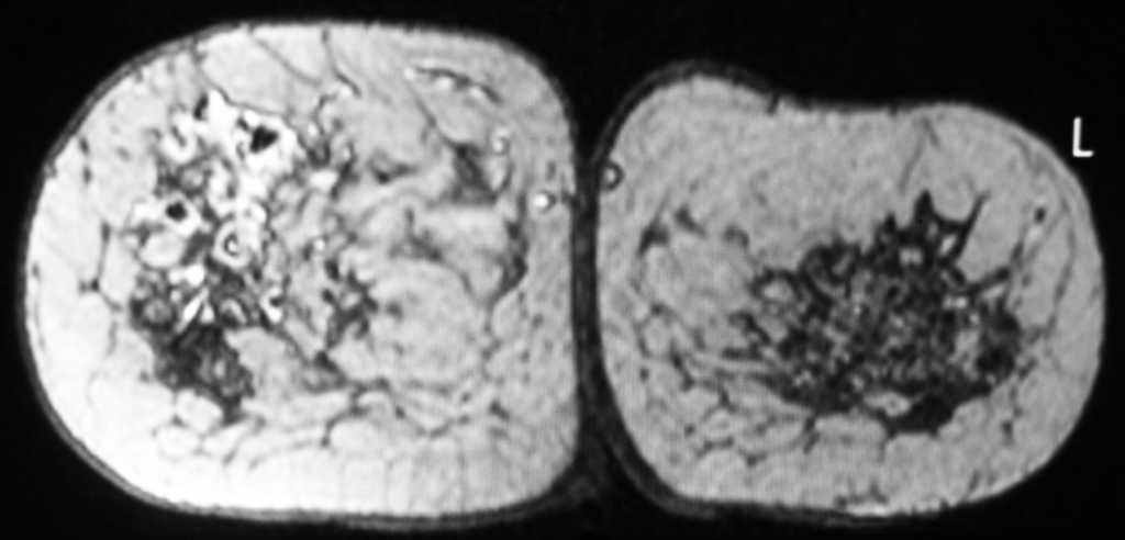 Tuberculosis mamaria. Descripción de los hallazgos de imagen en dos ...