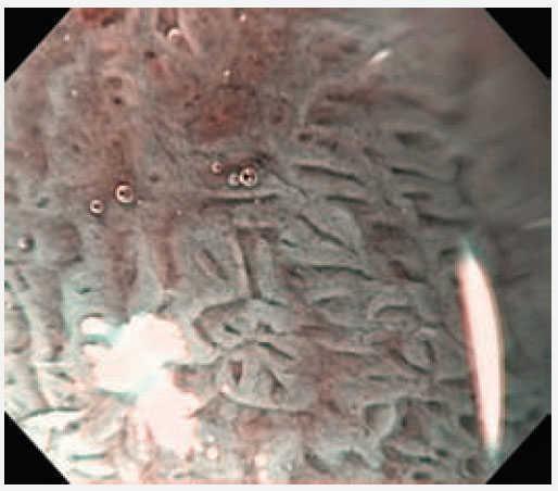 Esófago de Barrett | Revista de Gastroenterología de México