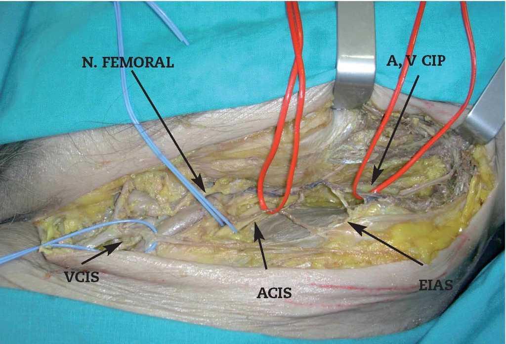 Colgajo de cresta ilíaca de doble pedículo vascular | Cirugía Española