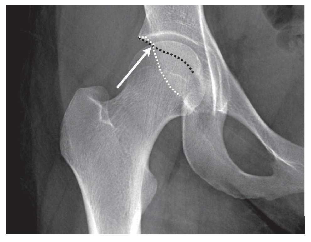 Resonancia magnética artrografía de cadera con énfasis en el ...