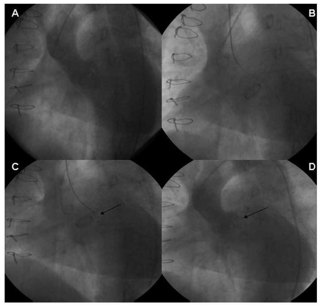 Closure of Perivalvular Leaks Using an Amplatzer Occluder | Revista ...