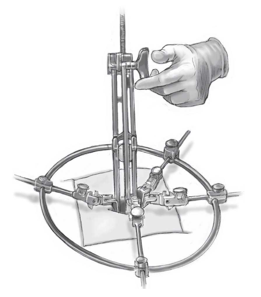 Colocación de una prótesis de disco intervertebral lumbar Prodisk ...