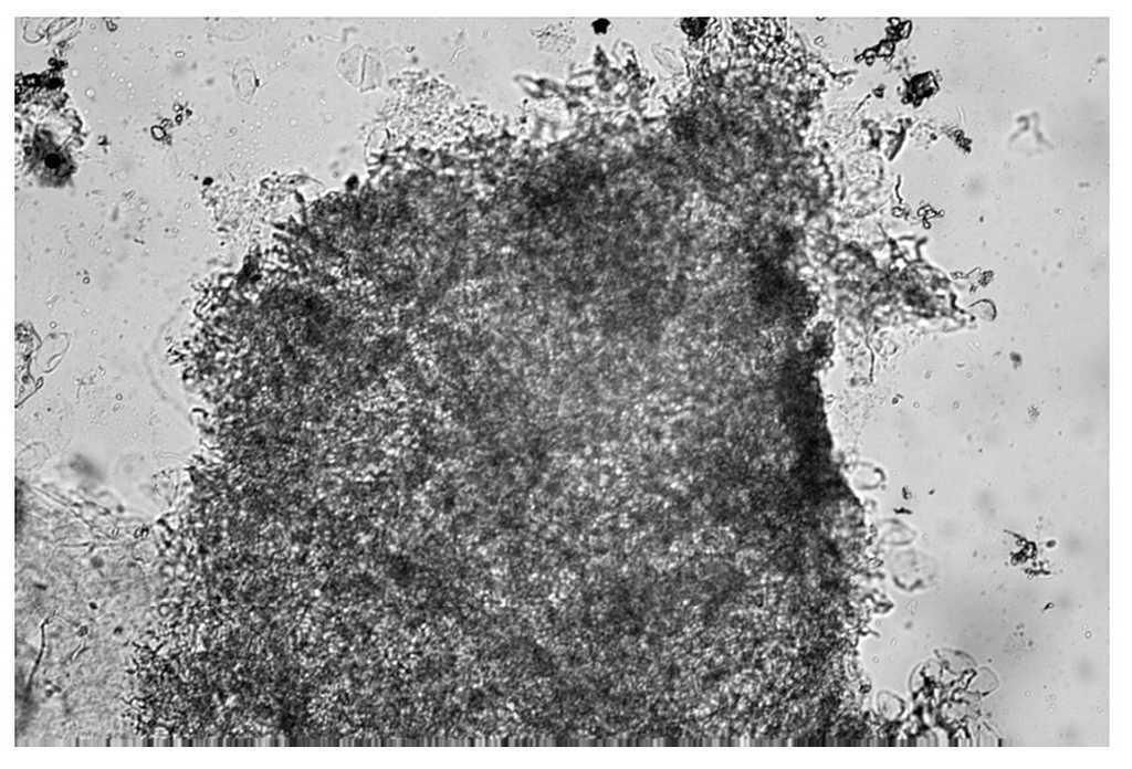 Dermatofitoma extraungueal | Revista Iberoamericana de Micología