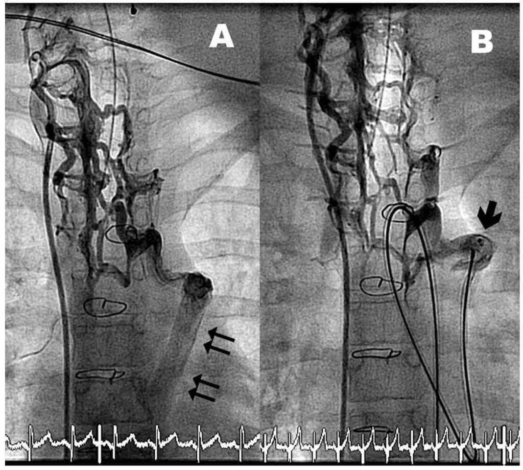 Percutaneous Embolization of Vascular Fistulas Using Coils or Amplatzer ...