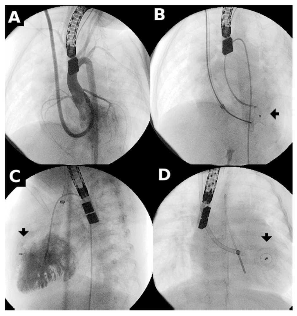 Percutaneous Treatment of Atrial Septal Defects, Muscular Ventricular ...