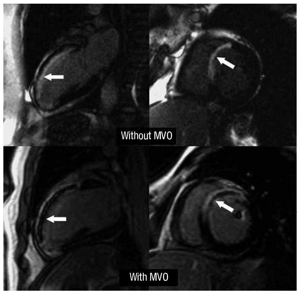 Post-Reperfusion Lymphopenia and Microvascular Obstruction in ST ...