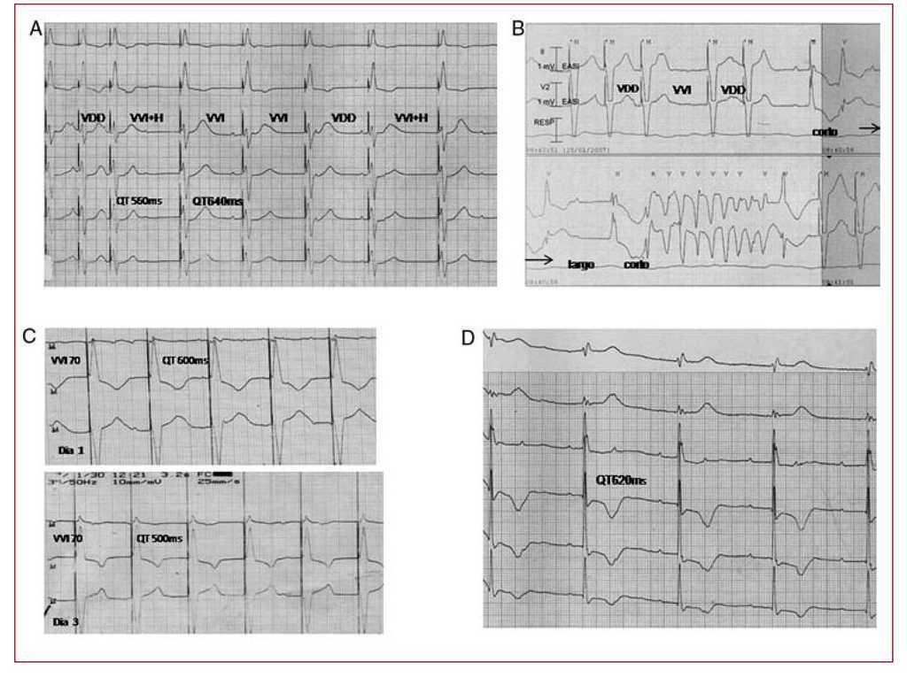 Intermittent Atrial Undersensing in Single-Lead VDD Pacemakers in ...