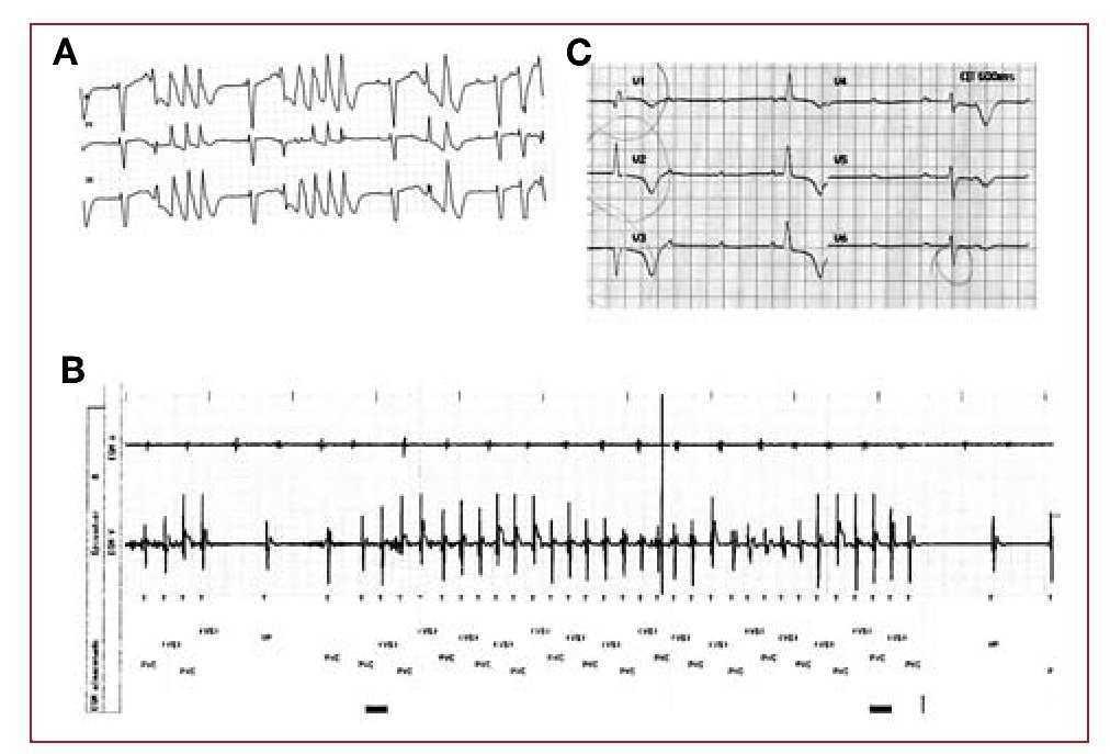 Intermittent Atrial Undersensing in Single-Lead VDD Pacemakers in ...