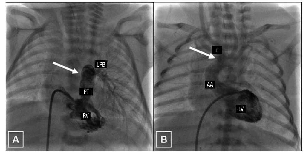 Disconnection of the Right Pulmonary Artery With Bilateral Ductus ...
