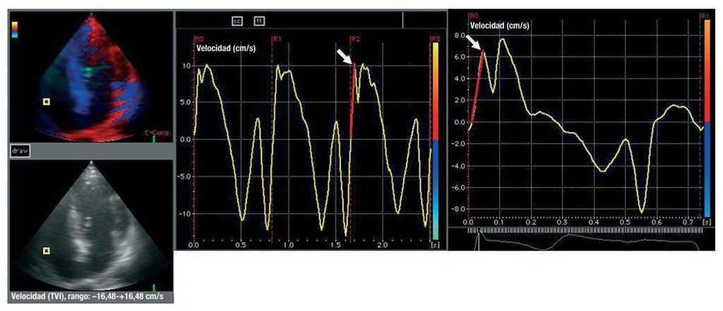 Utilidad de la aceleración isovolumétrica y los parámetros de ...