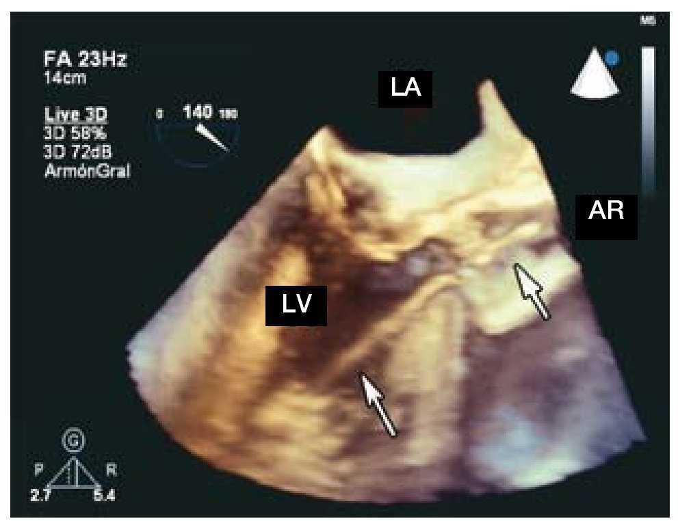 Intraoperative Monitoring With Transesophageal Real-Time Three ...