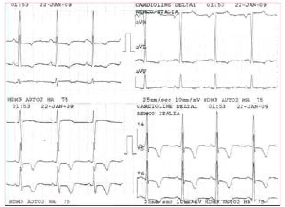 Left Ventricular Hypertrabeculation or Noncompaction: Are New ...